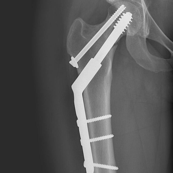 Orthopedic Hardware - Part 1 - by Alexander Baxter