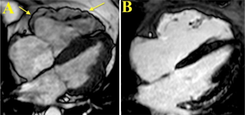 Cardiopatia Arritmogênica