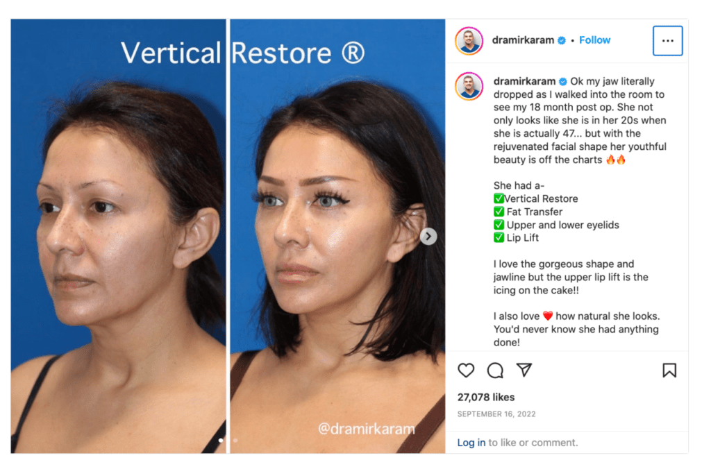 Lower and Vertical Facelifts. Part 1.