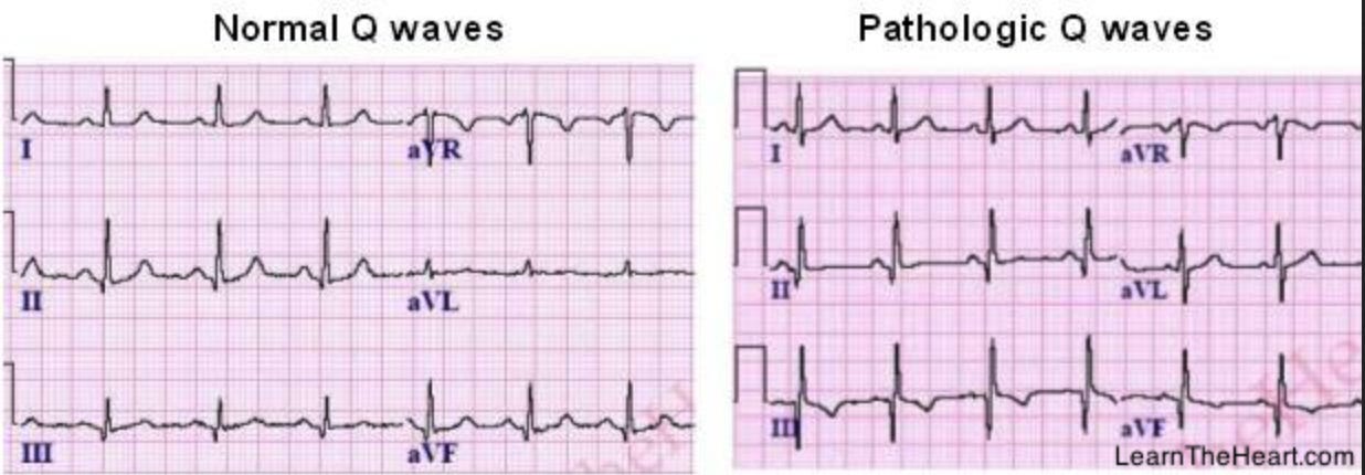 ATTENTION PILOTS with an EKG Showing Prolonged PR Interval: One 2009 ...