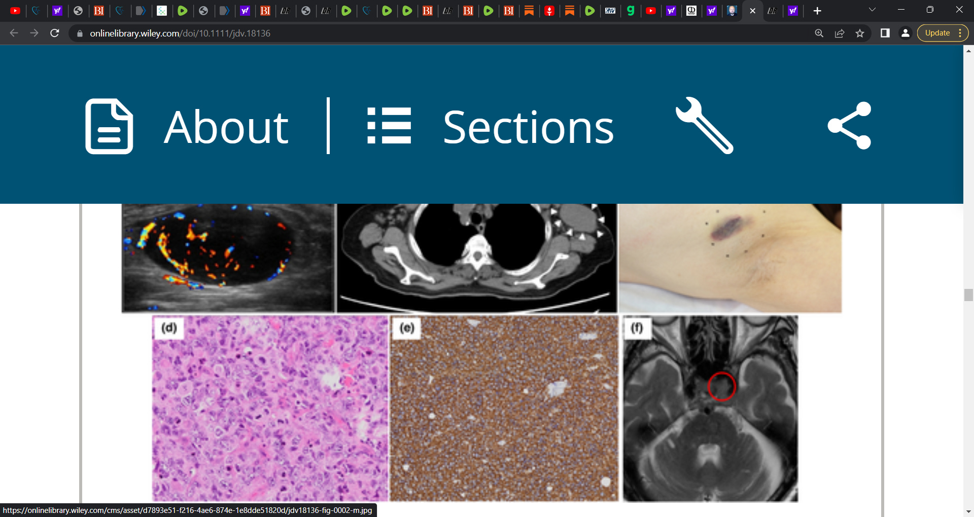 Vicious rapid aggressive lethal TURBO cancer in 2 patients, 1 day & 2 ...