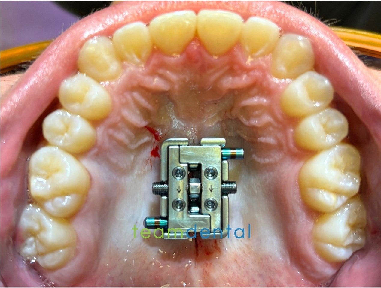 5.5 MARPE Failure to Split, Molar Tipping and Over-Expansion Problems
