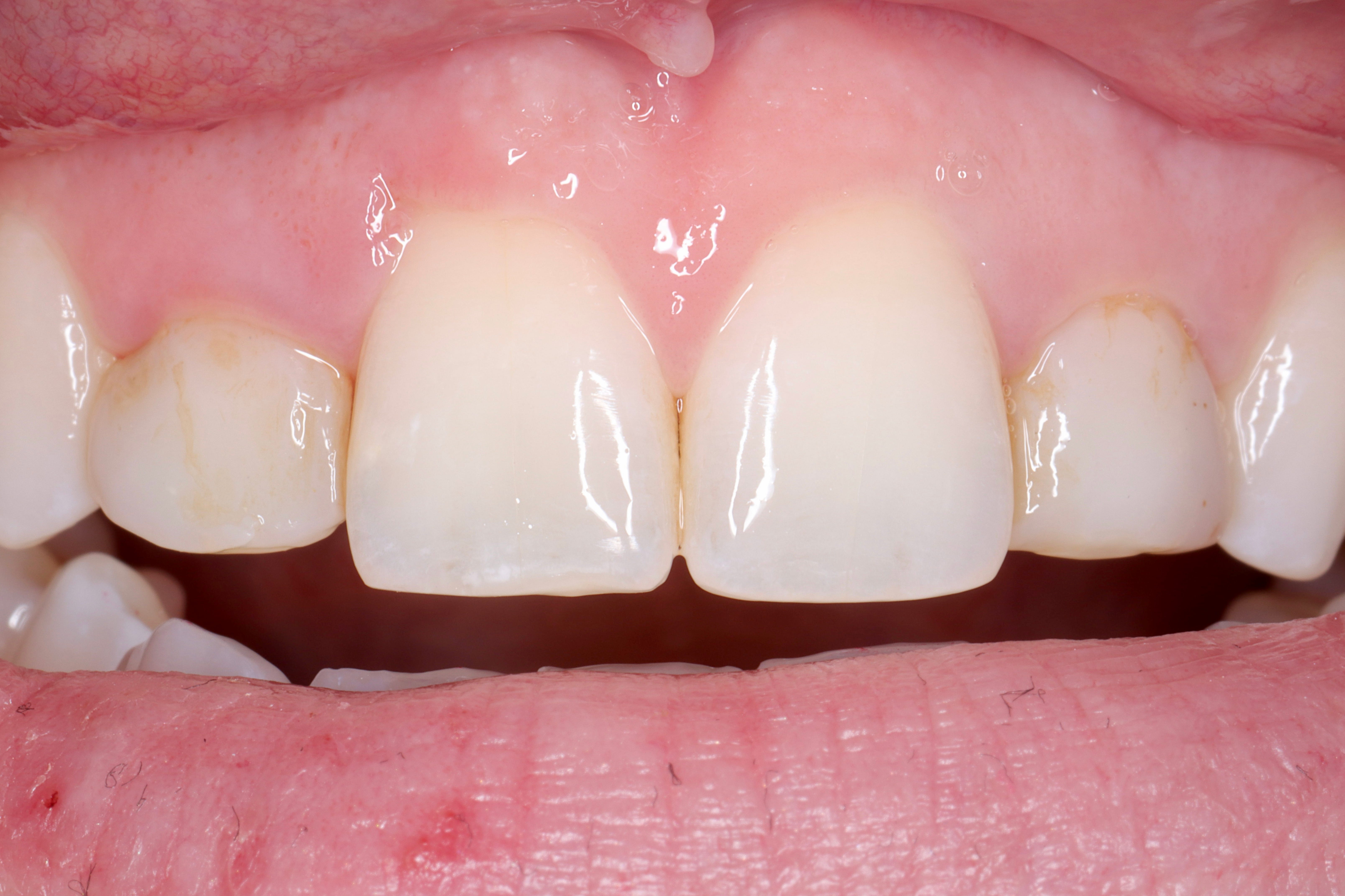 Peg Lateral Rejuvenation - by Brandon Walker, D.D.S.