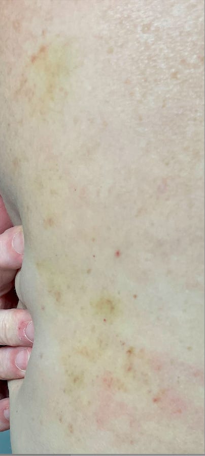 "Shedding" Part 9 - More and More Clinical Case Descriptions of ...