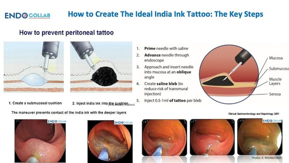 Master the Art of Endoscopy Tattoos