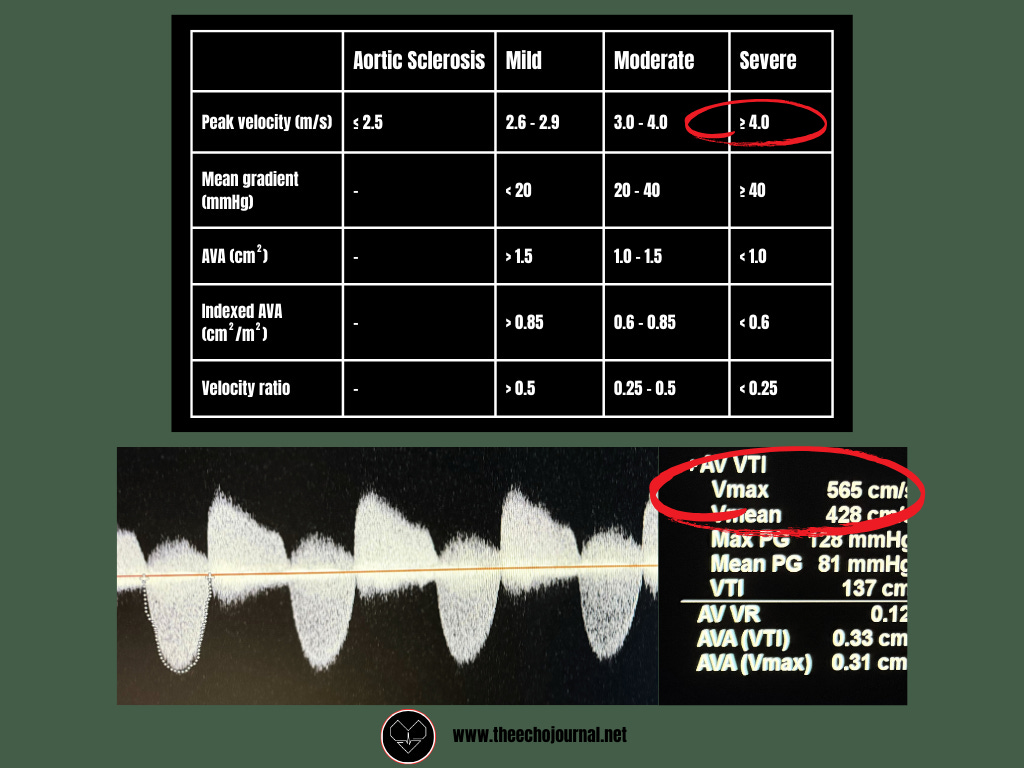 Grading Aortic Stenosis - by Alex C. - The Echo Journal