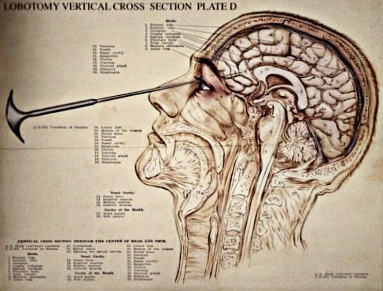 The Modern Day Lobotomy - by Torrance Stephens, PhD