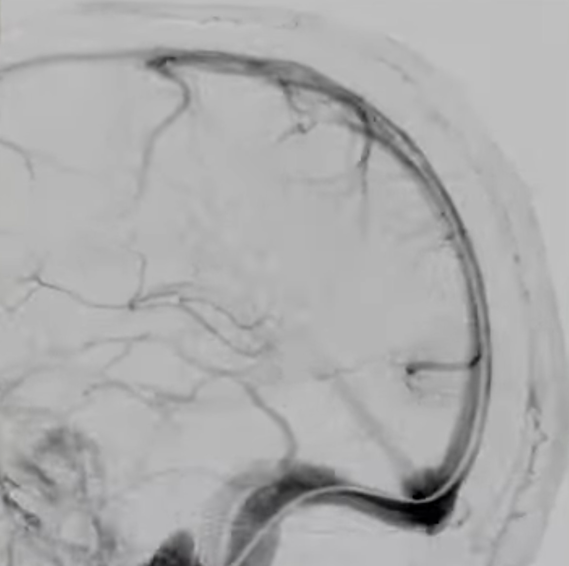 Endovascular Brain Computers, Electricity from Air and a Robot Lawyer