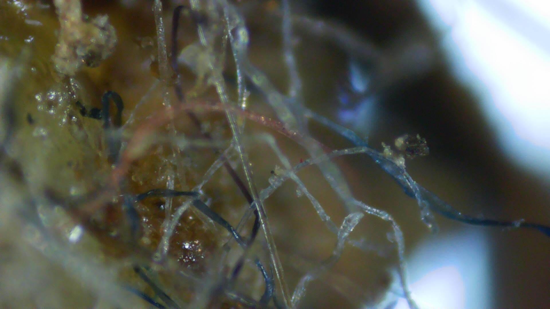 Morgellons Like Filament Tumor Found In Nasal Cavity With Insect ...