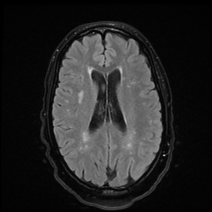 White Matter Lesions in Migraine - Sapien DNA