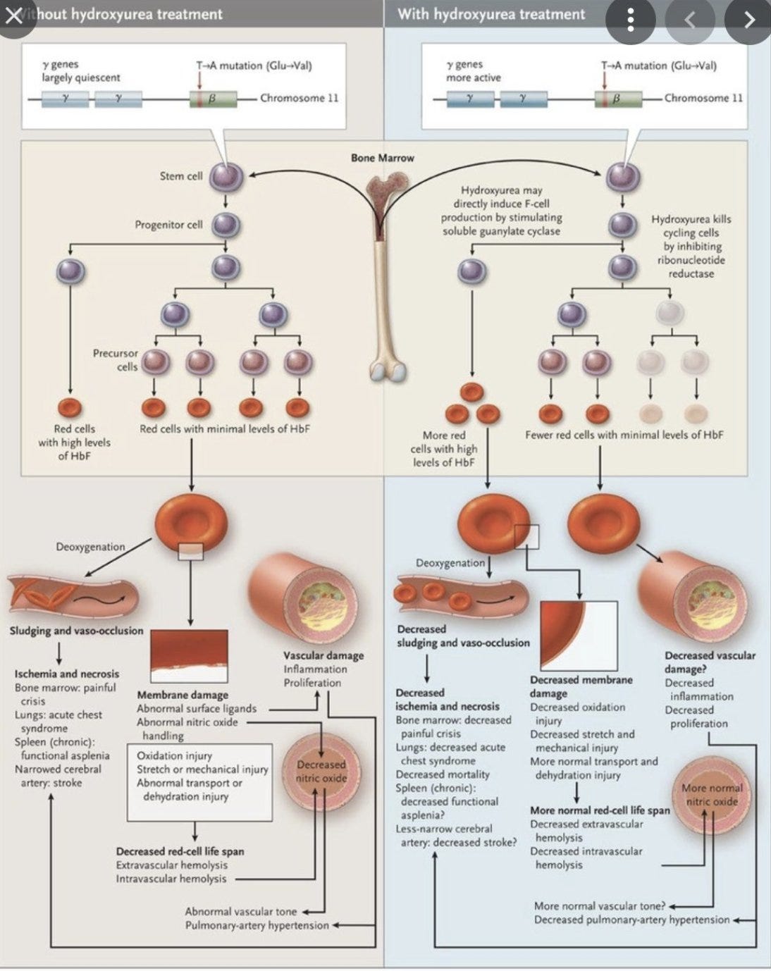 Hydroxyurea Sickle Cell Anemia!