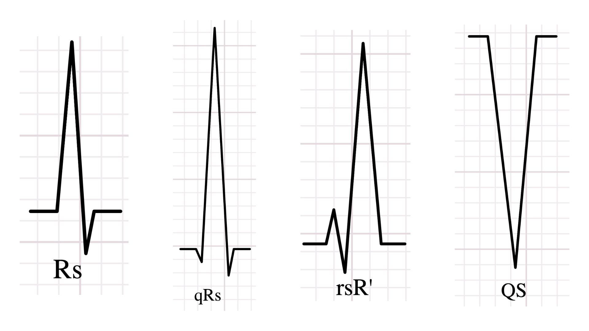 QRS Complex Nomenclature and Morphology
