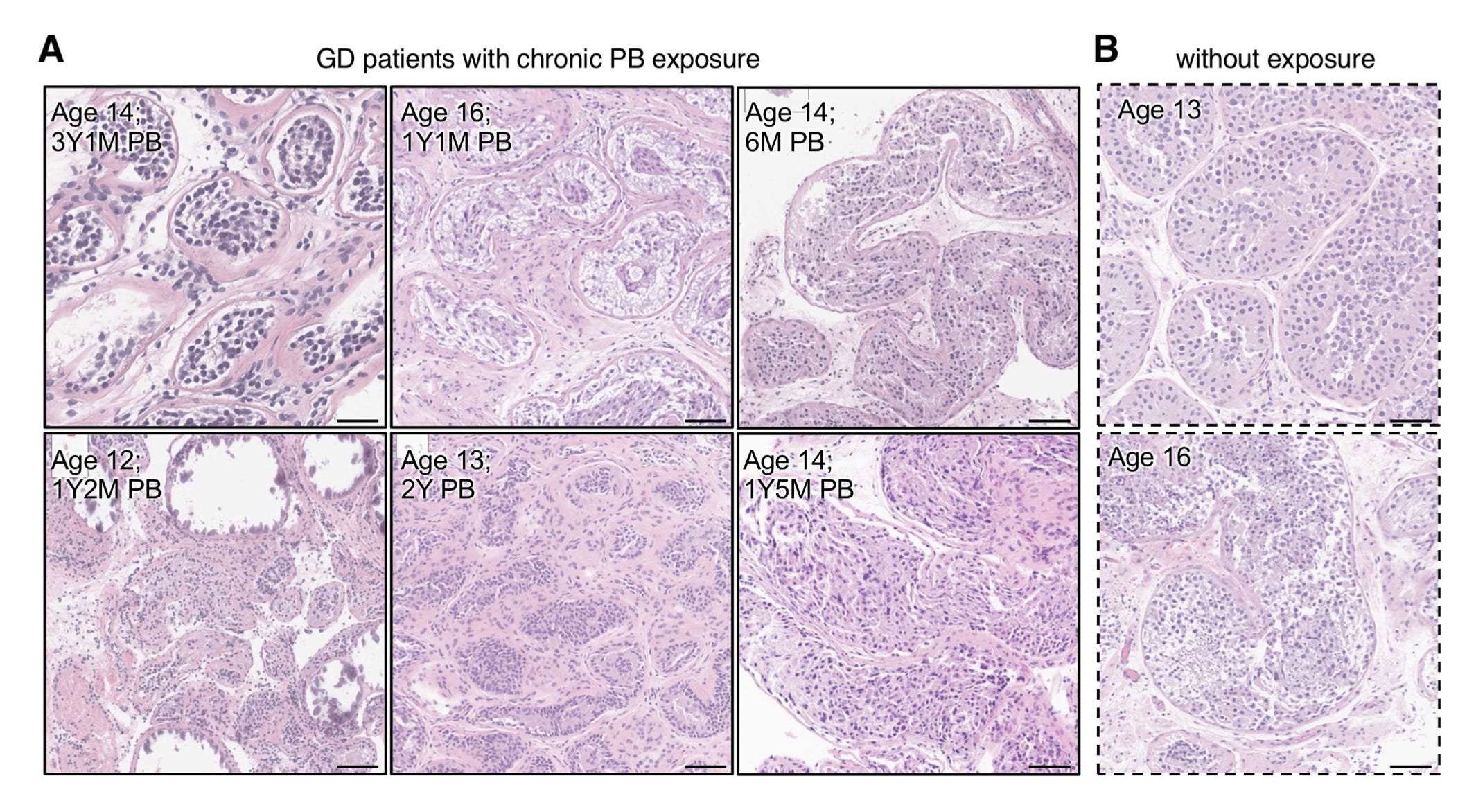 New Mayo Clinic study finds mild to severe atrophy in testes of boys on ...