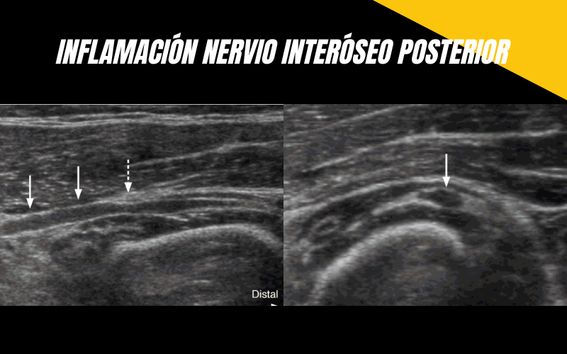 Nervio interóseo posterior - by Tempo Formación