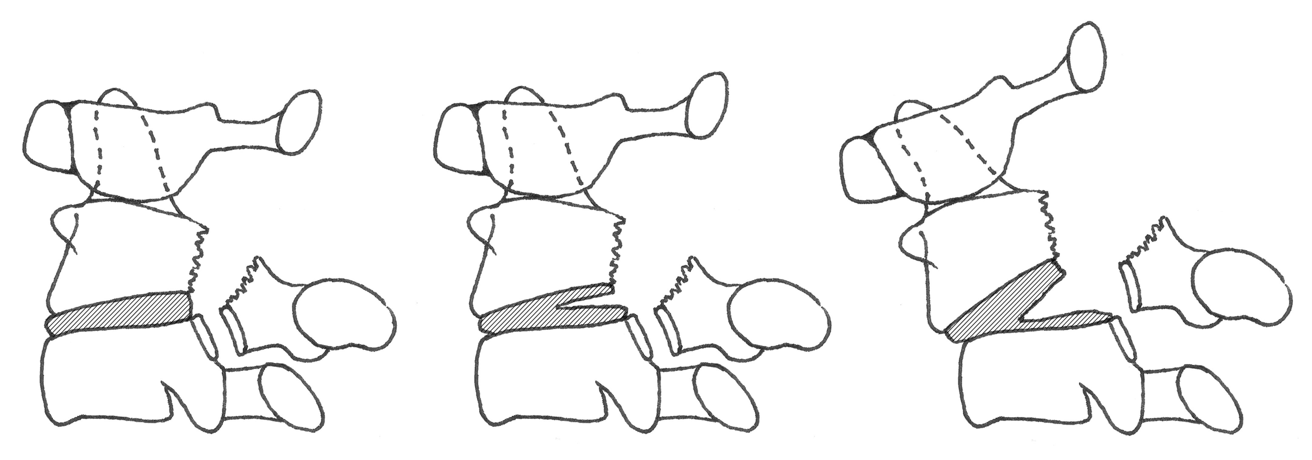 Traumatic C2 spondylolisthesis (Hangman fracture)