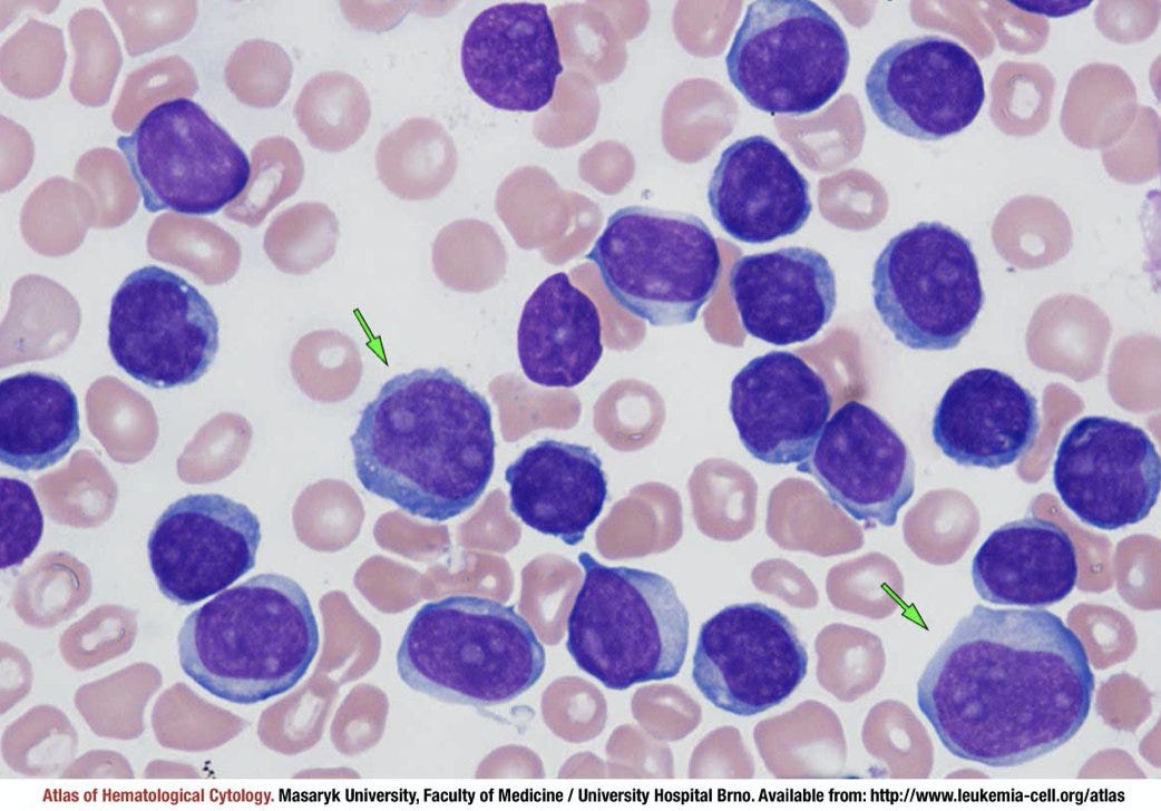 Learn Mature B-cell Leukemia flow patterns by CD5/CD10!