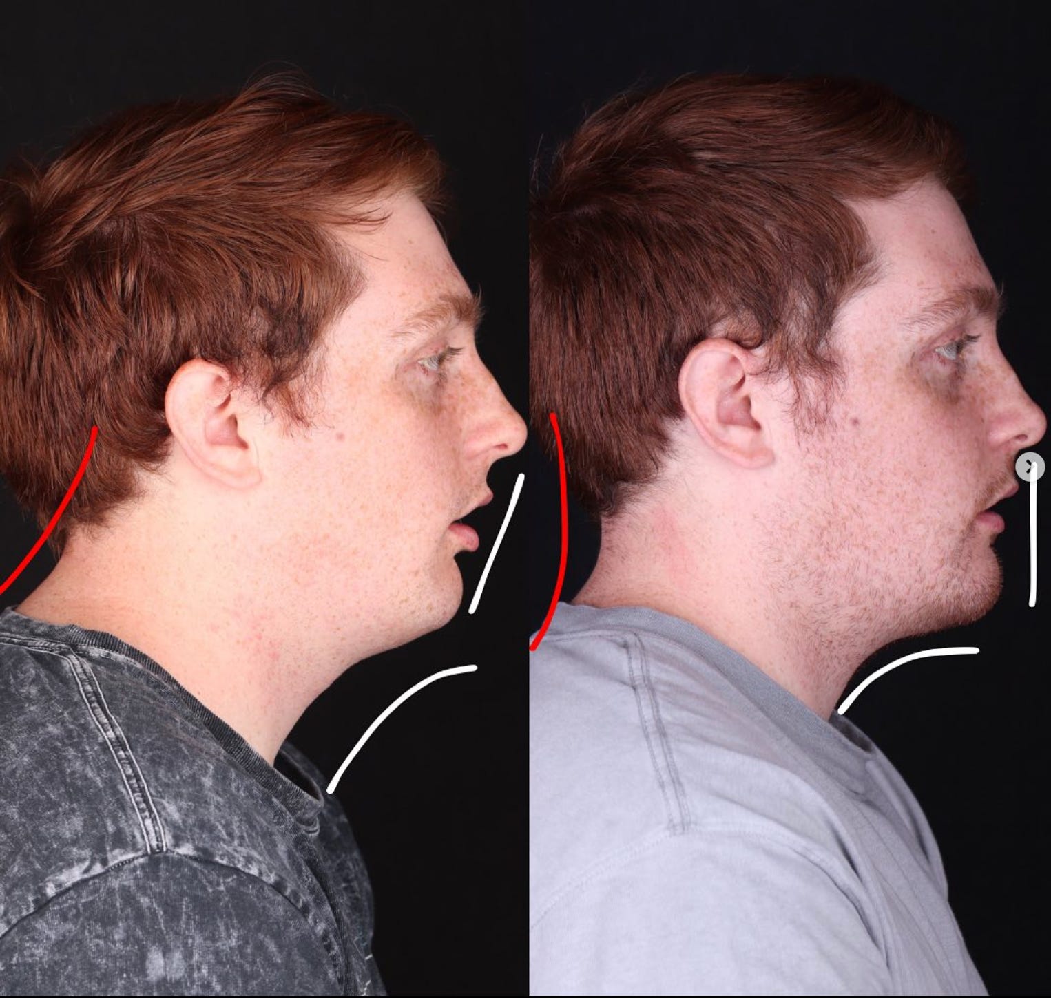 2.3 Mewing is More Than Just Tongue Posture - by Ronald Ead