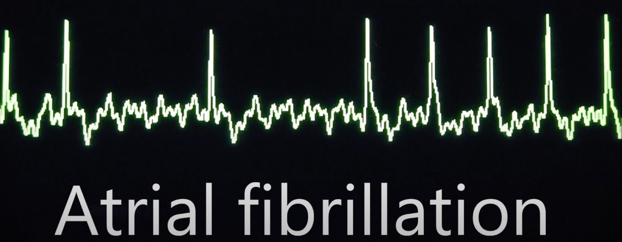 A quite astonishing rise in the number of people diagnosed with atrial ...
