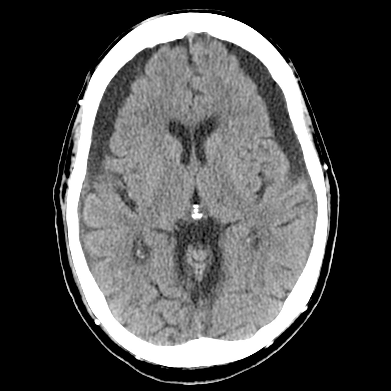 Subacute and chronic subdural hematoma