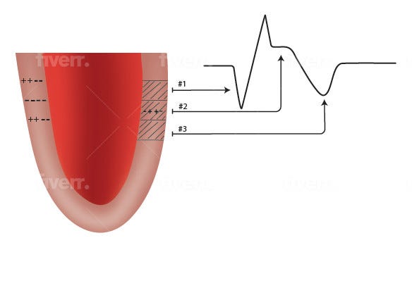 How Do Myocardial Infarcts Create Q Waves?