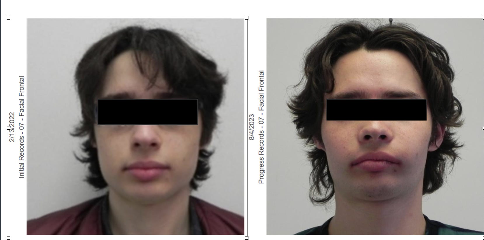 Dr. Newaz’s Talk on Bone-Anchored Expansion – Part 1 – JawHacks