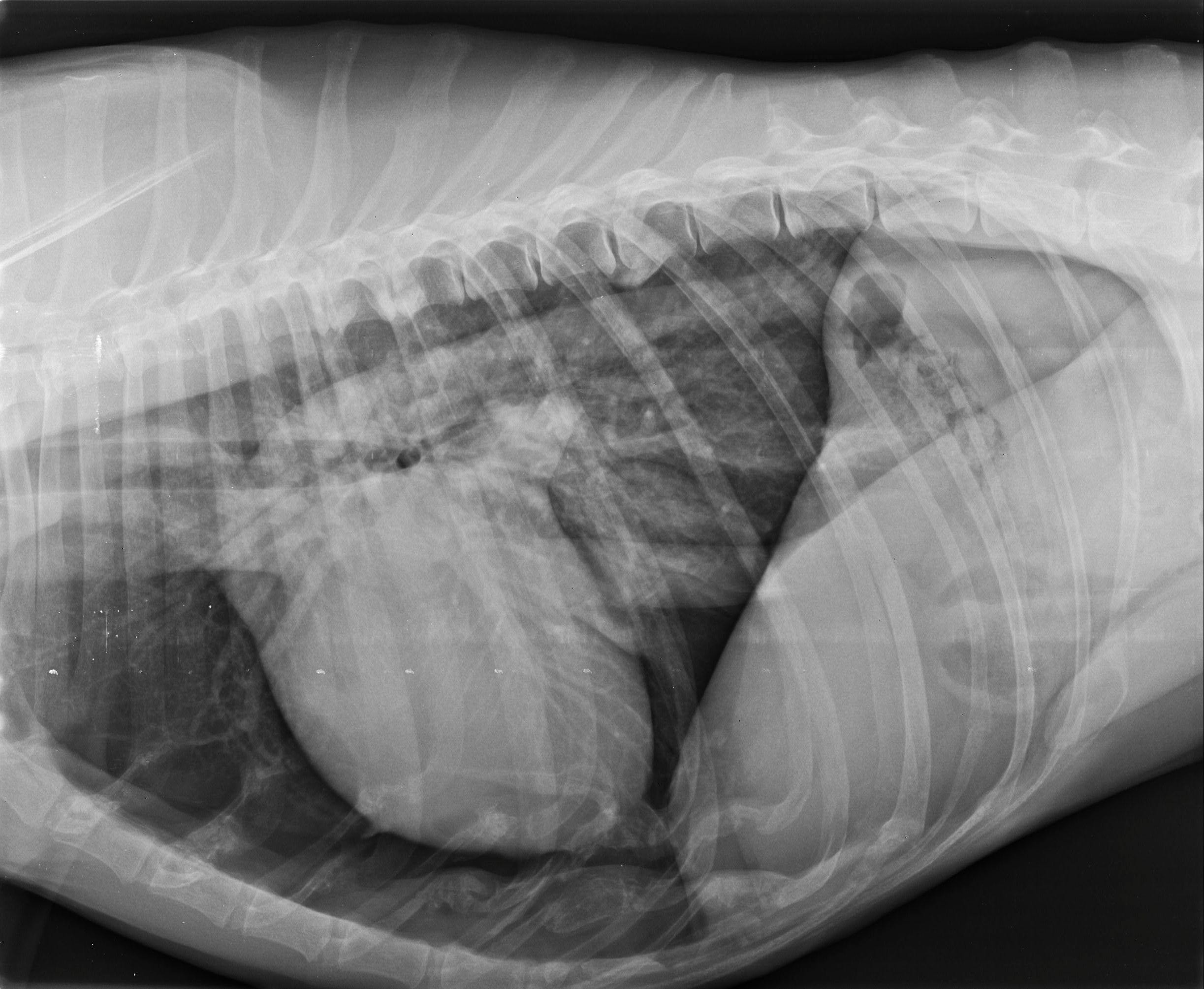 Neumotórax asociado a bullas pulmonares tratado con pleurodesis (II)