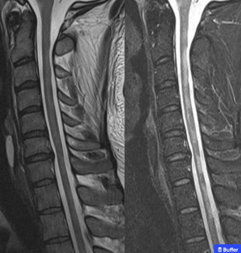 Q&A 36: when to do a spinal MRI - by Gavin Giovannoni