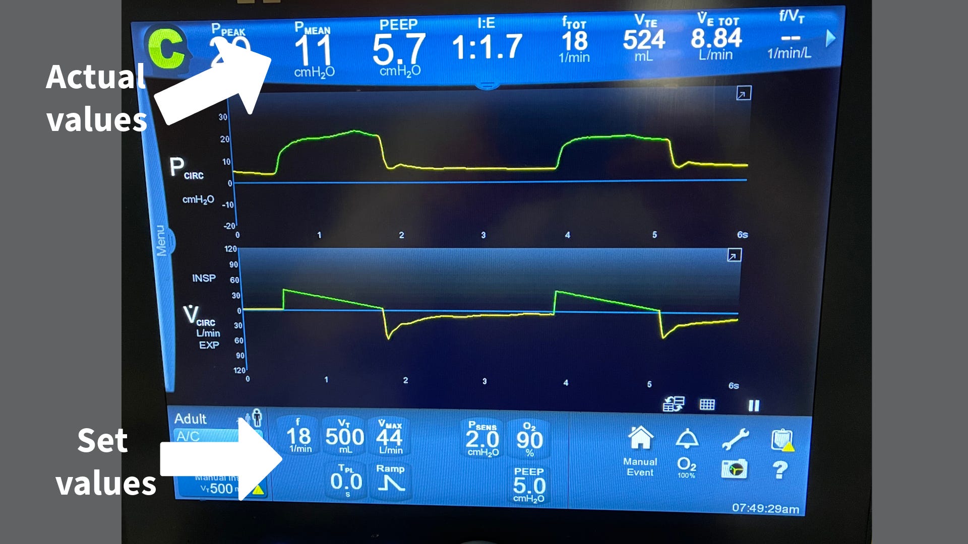 Mechanical Ventilation Made Simple: 9 Concepts Every Non-ICU Doc Should ...