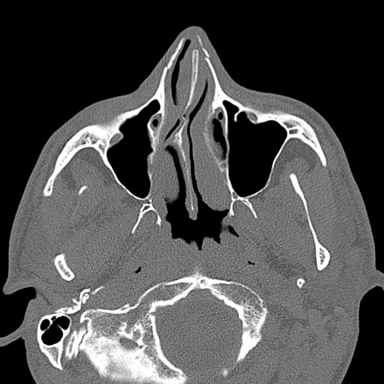 Nasal and Naso-orbito-ethmoid Fractures