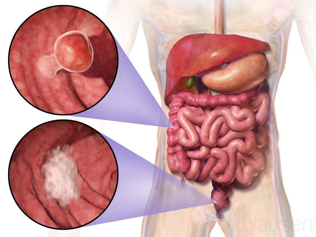 Rectal bleeding: how to approach symptoms that may or may not be ...