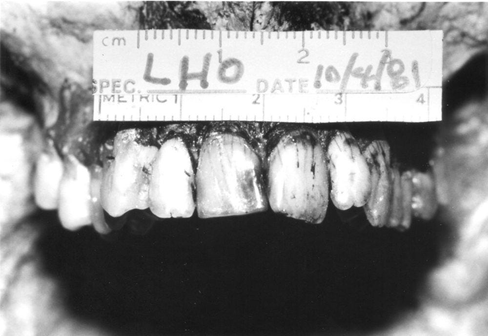 Lee Harvey Oswald Body