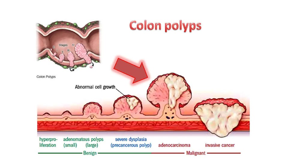 3,2,1: Muerte, creatividad y colonoscopia