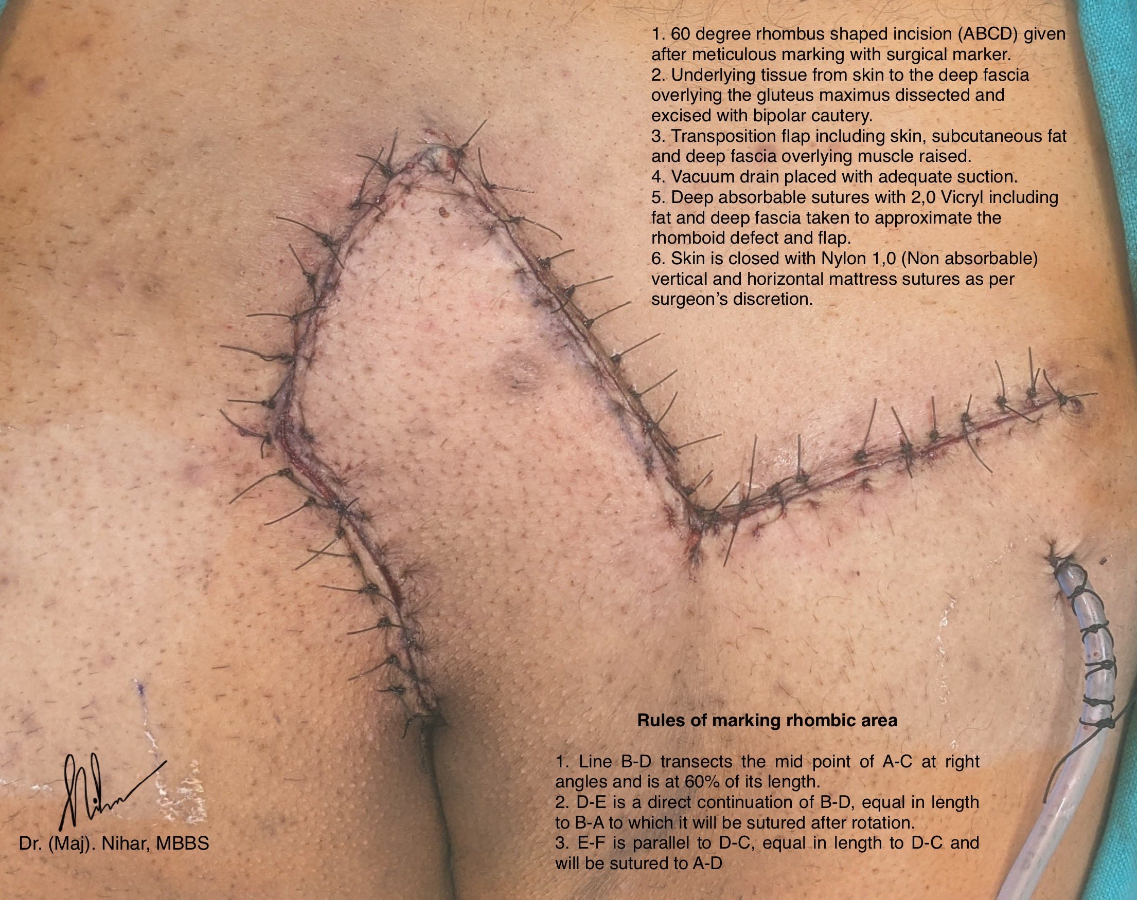 104 Pilonidal Sinus - Limberg’s Flap - by Dr. (Maj.) Nihar