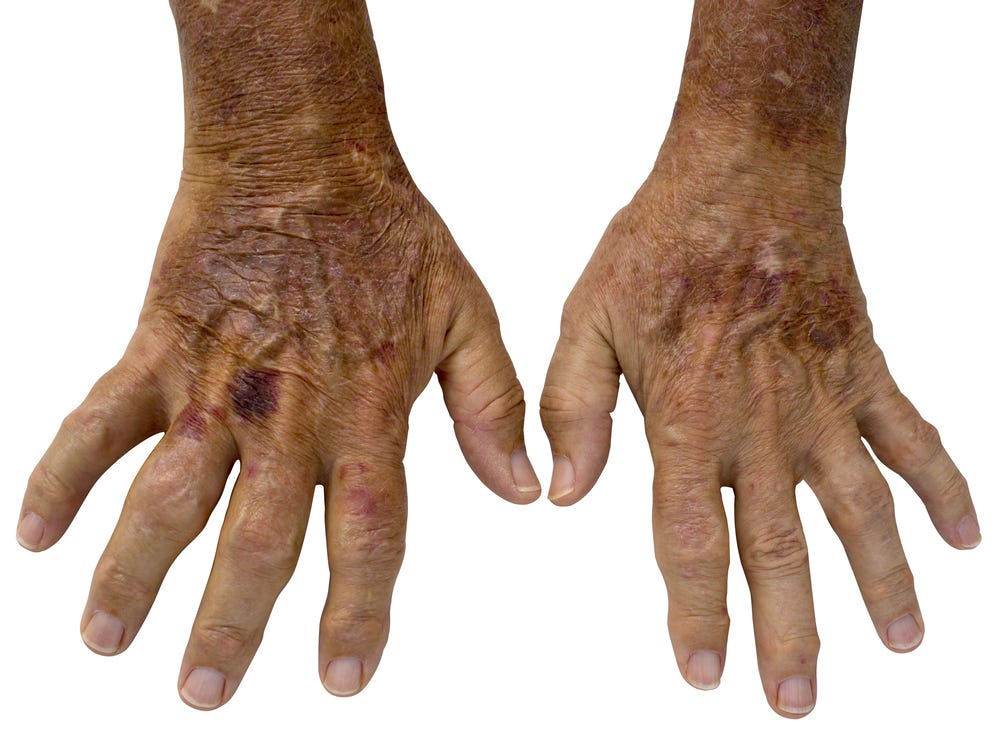 Age spots inside your body are toxic lipofuscin