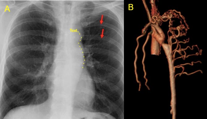 Coarctação da aorta
