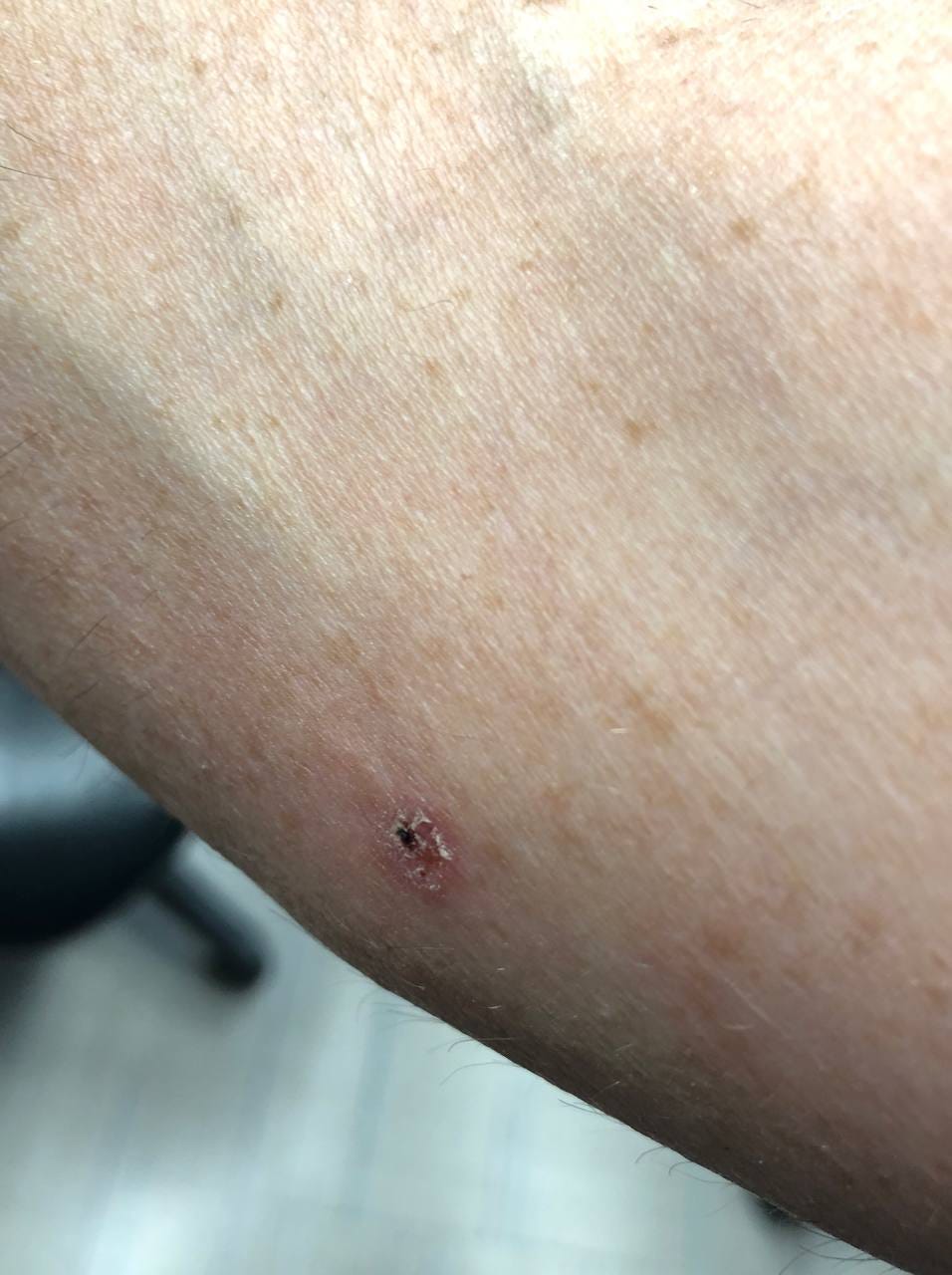 Eliminate Ear Infections, Remove Skin Cancers, Heal Spider Bites, and more