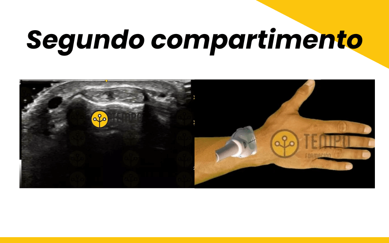 Compartimentos extensores de la muñeca - by Tempo Formación