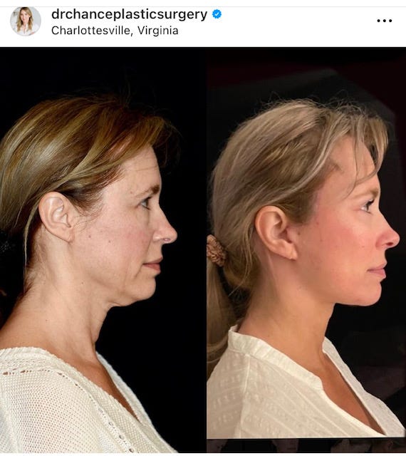 The Insta-Famous Facelift - by Jolene Edgar