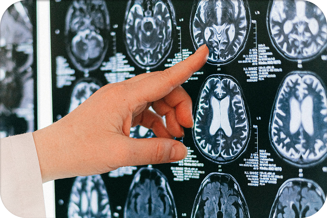 Anavex's Phase 2b/3 Alzheimer's Data | Cancer Detection and Treatment ...