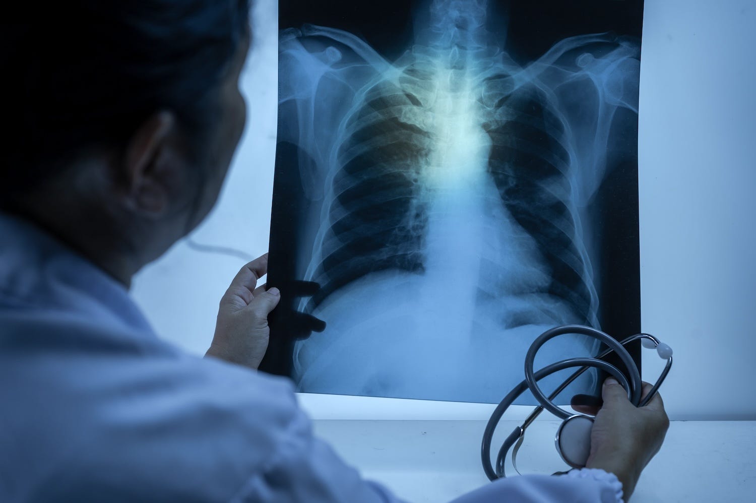 Tuberculosis outbreak in Kansas is "largest" in U.S. history, says report