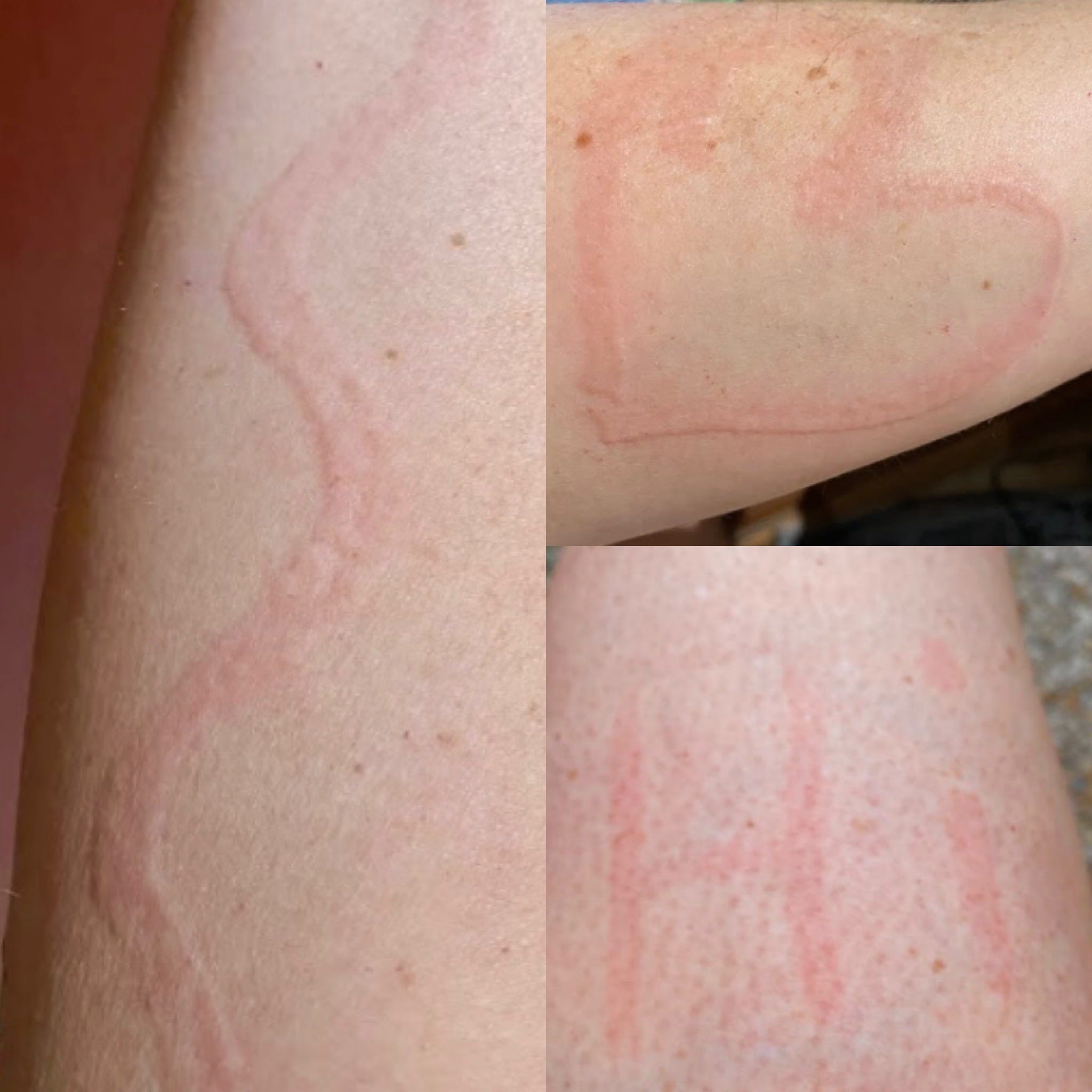 NYT's big article on vaccine side effects is a long time coming