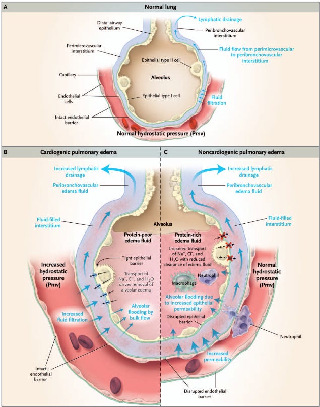 Como avaliar congestão pulmonar?