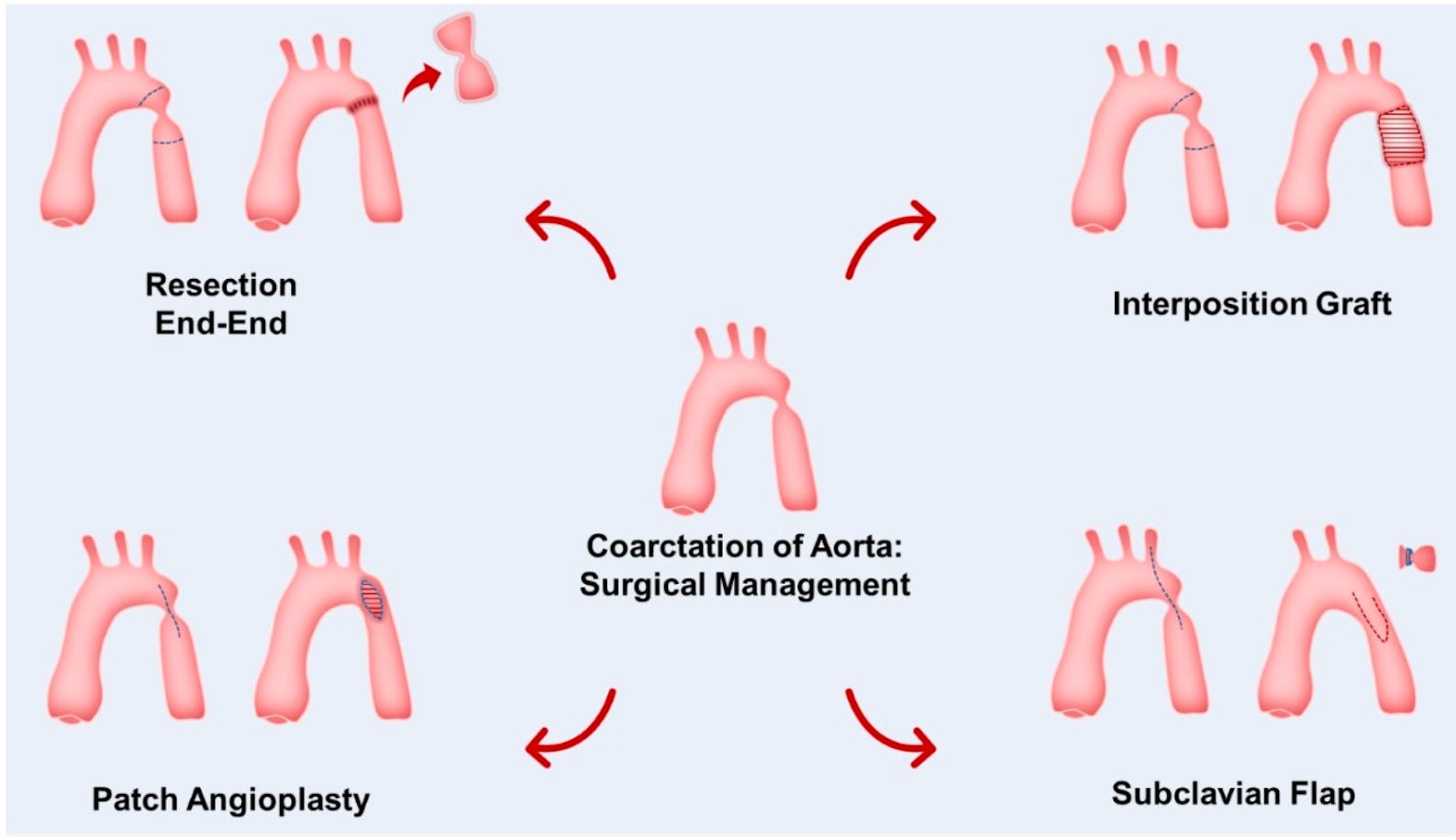 Coarctação da aorta