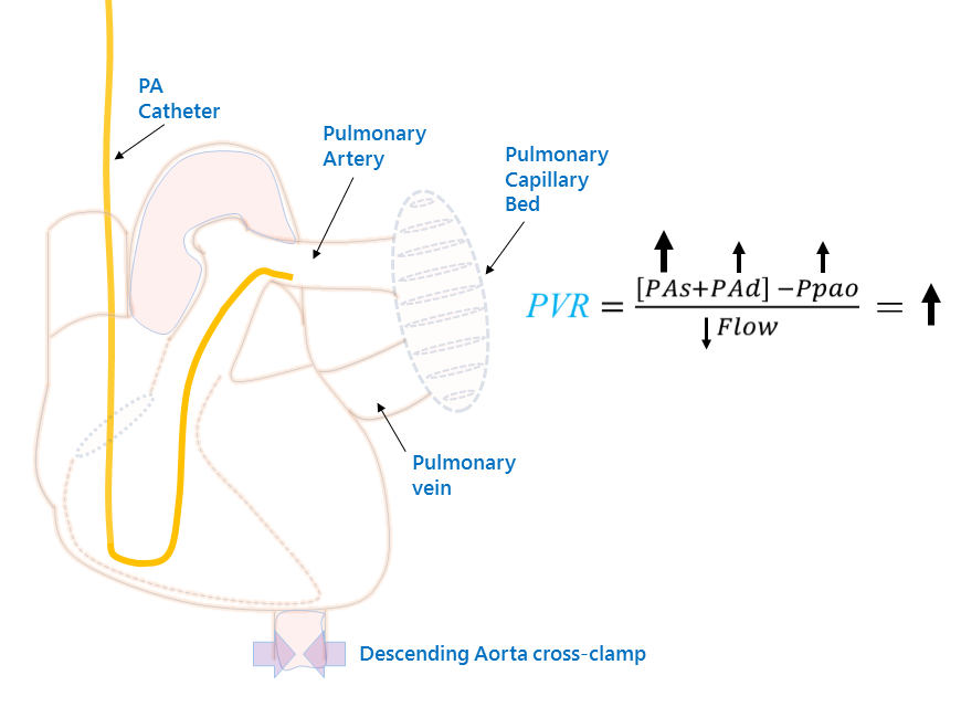 ICU Physiology in 1000 Words: The Folly of Pulmonary Vascular Resistance