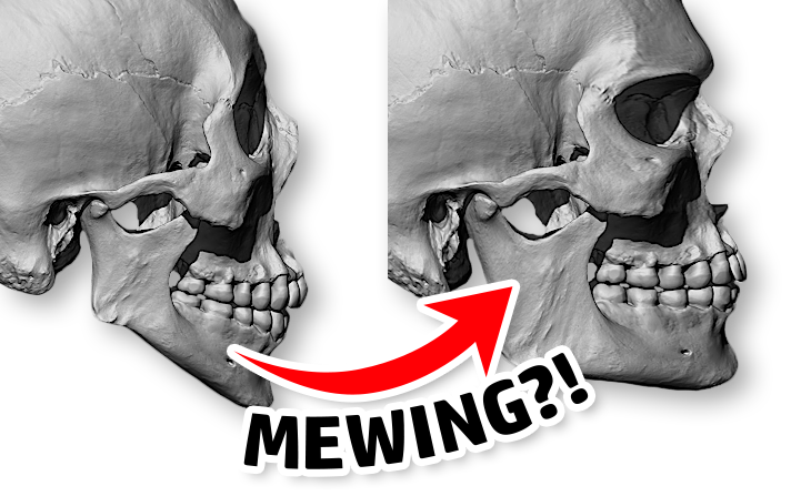 2.5 My Own Failed Attempt at Hard Mewing - by Ronald Ead