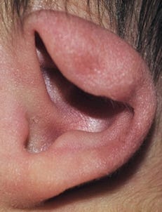 Pediatric Pearls: Infant's Ear - Pits, Tags, and the Pinna