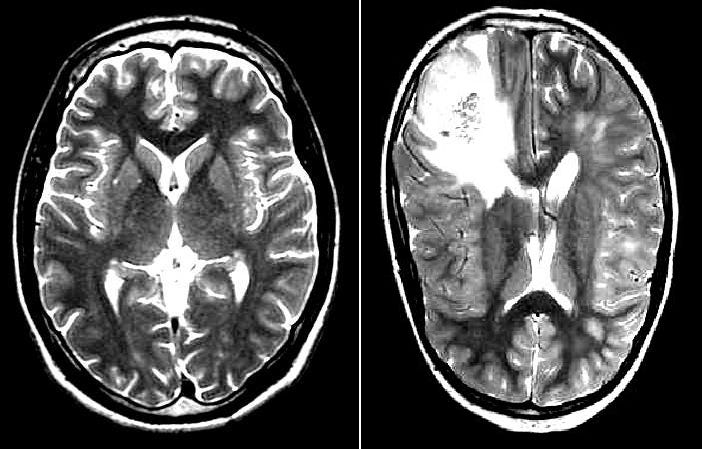 Fine-Tuning Vision Transformers (ViT) for Brain Tumor Image ...