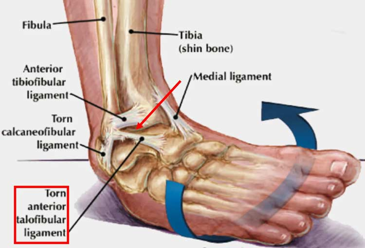 Ligamentous Laxity and Vaccine Injuries