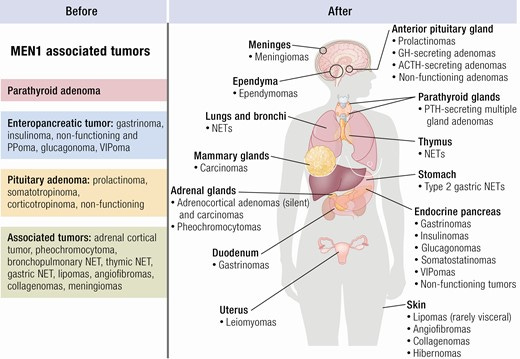Multiple Endocrine Neoplasia Type 1 - by Stetson - Holodoxa