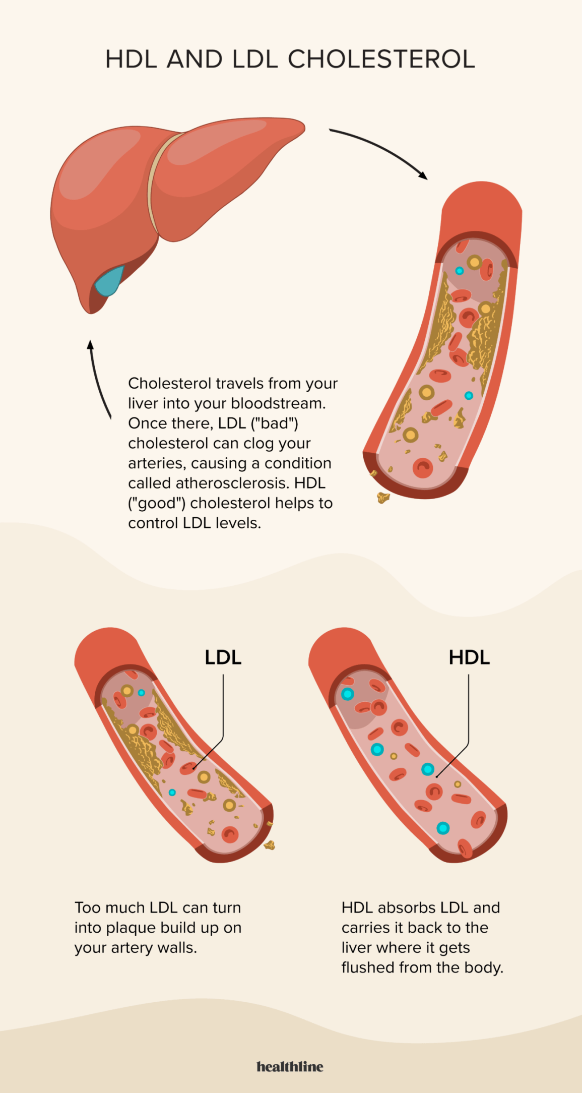 Cholesterol, statins & heart disease